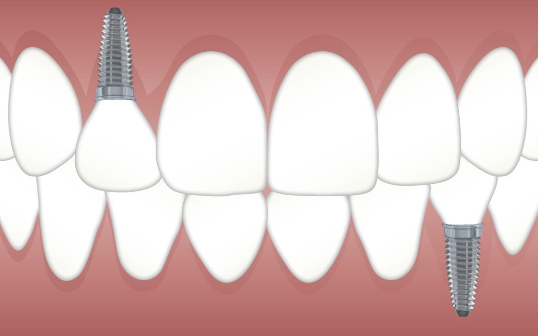 How Much Do Dental Implants in Rochester, NY Cost?