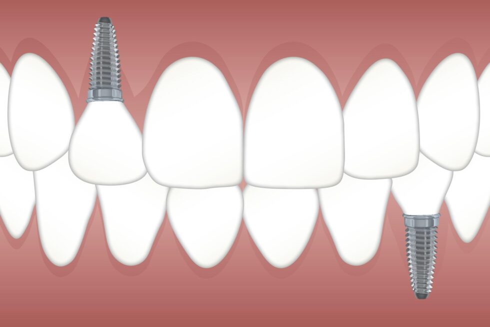 How Much Do Dental Implants in Rochester, NY Cost?